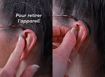Comment mettre un appareil auditif RIC à embout ? - Laboratoires Unisson